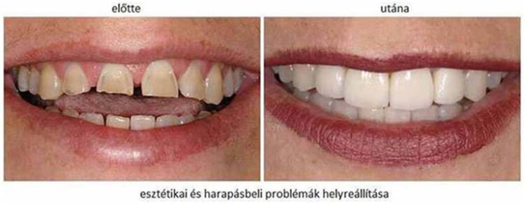 Cirkon koronák – Fogászat Budapesten | Villányi Dent